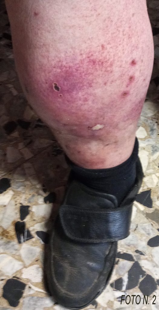 Su un caso di miasi - Toscana Medica